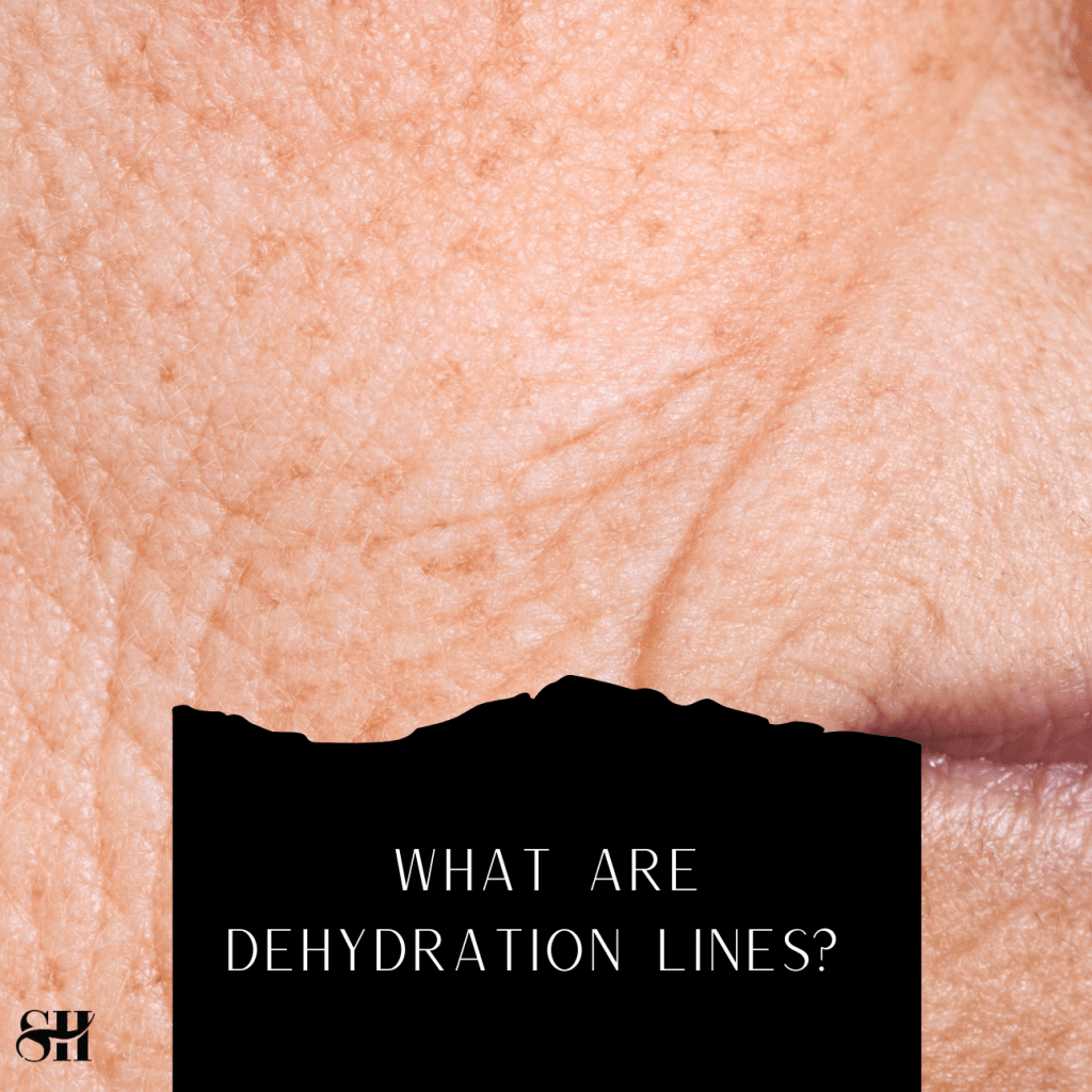 What Are Dehydration Lines? - Skin Harmonics